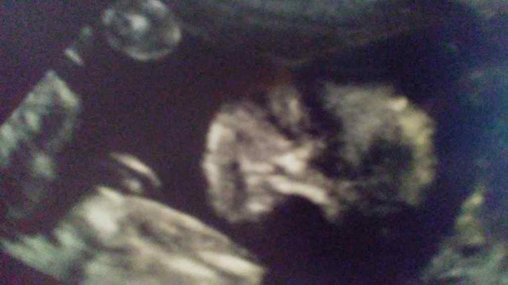 Vasectomy Testimonials Minneapolis | Orlando | FL | St Paul | MN