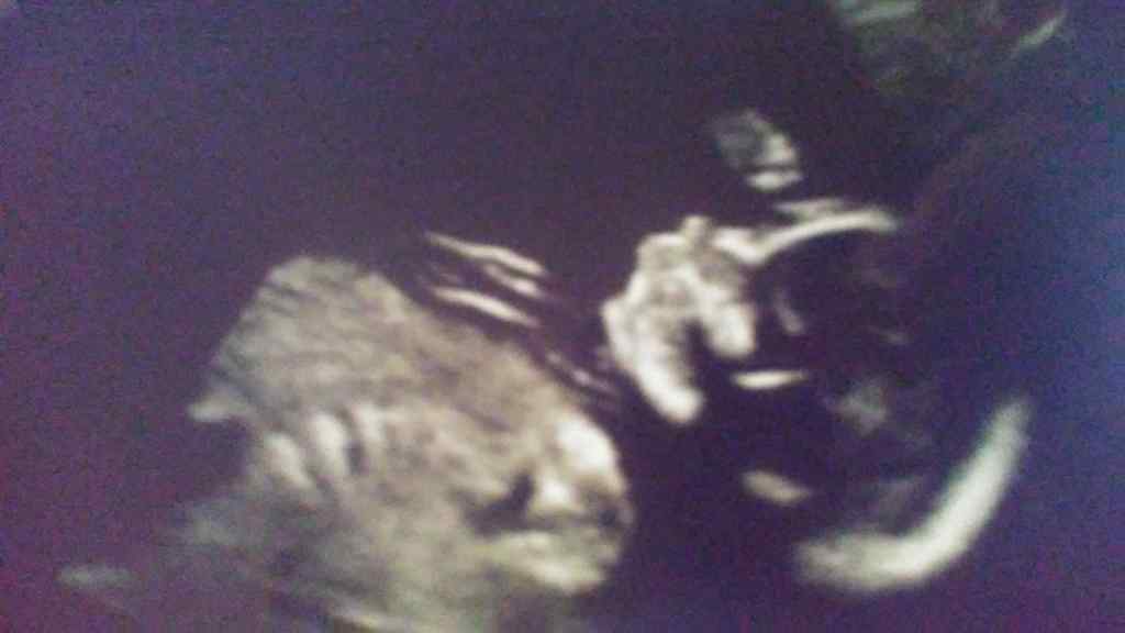 Vasectomy Testimonials Minneapolis | Orlando | FL | St Paul | MN